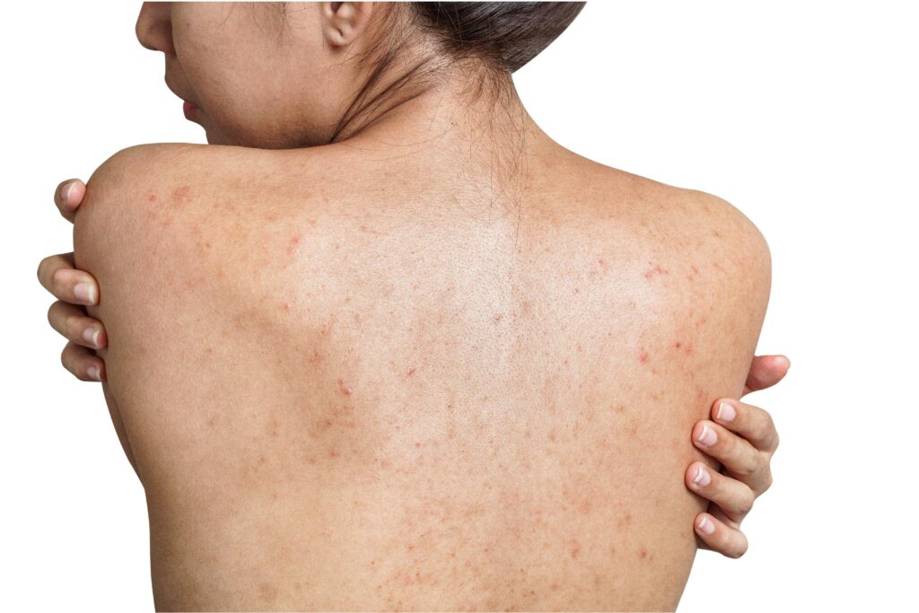 Back Acne: What is Bacne? | CLNQ