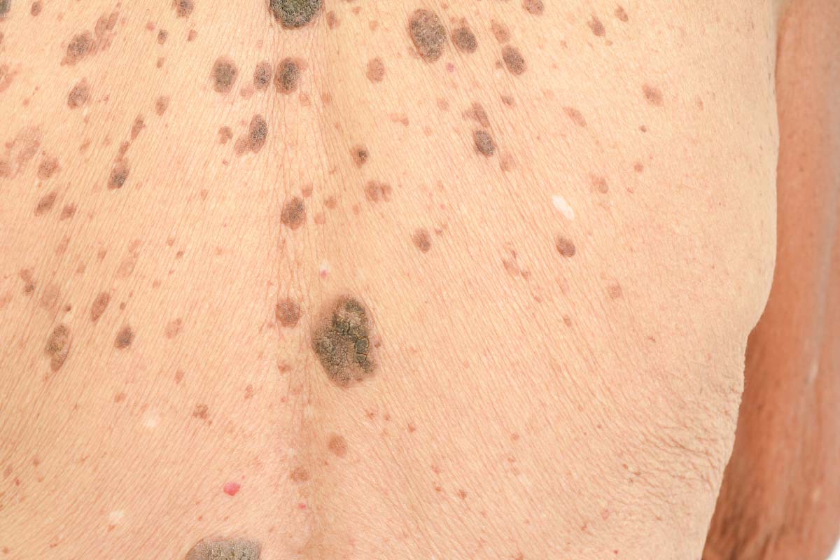 Seborrheic Keratosis (Senile Wart) Removal in Manchester | CLNQ