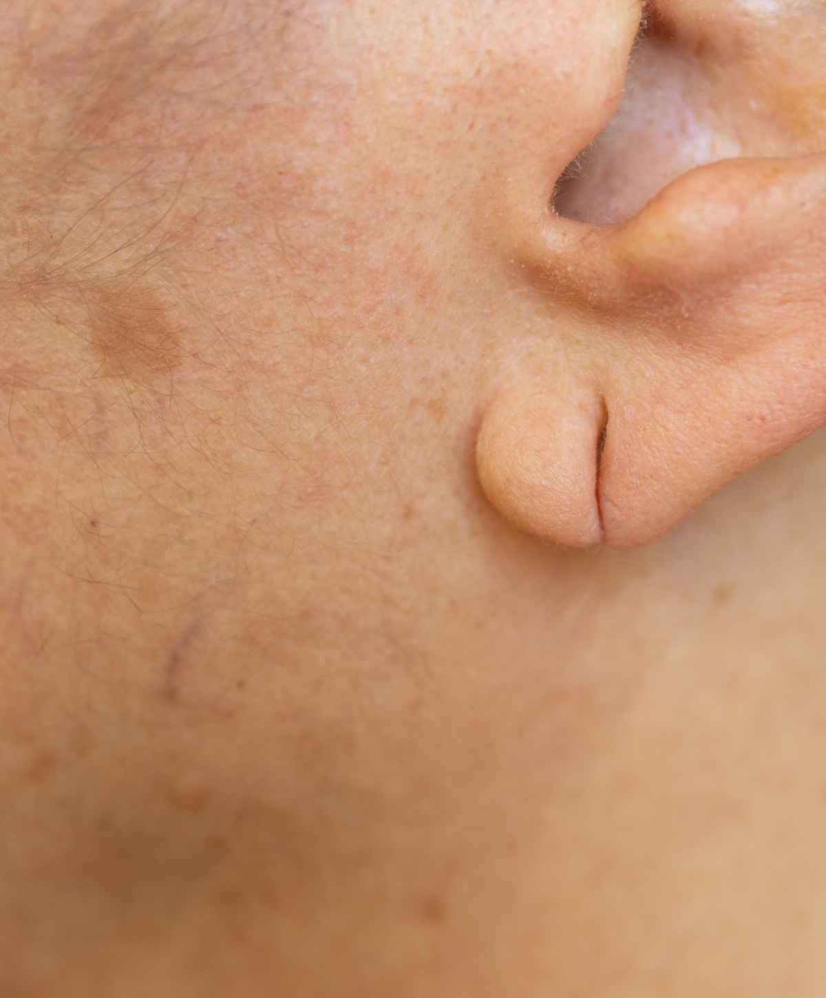 Earlobe Repair Manchester and Cheshire | CLNQ Clinic
