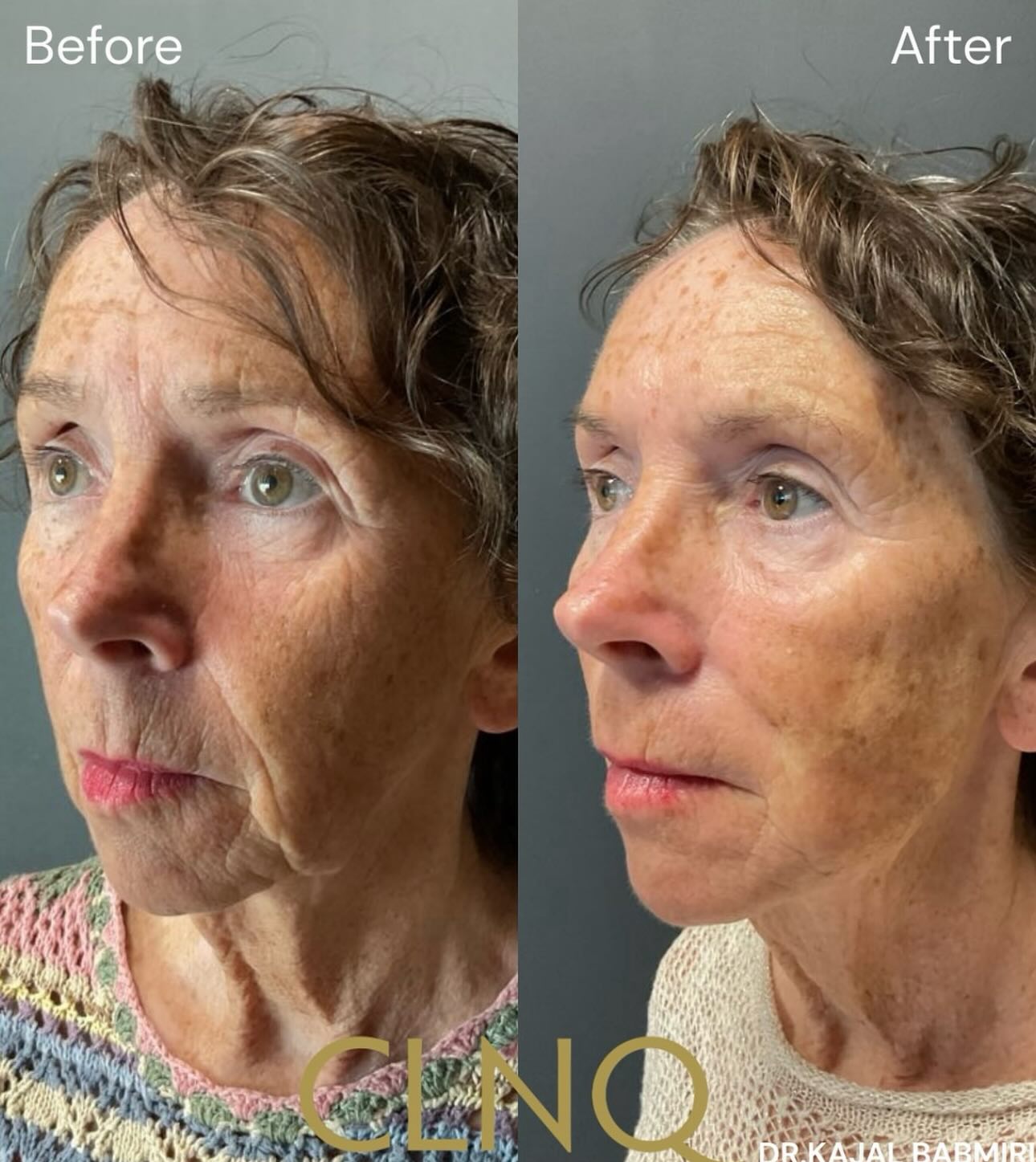 Thread Lift vs Facelift - CLNQ Manchester | Cheshire | Medical Surgical ...